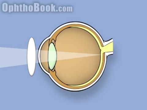 Retinoscopy of the eye (Ophthalmology) - YouTube