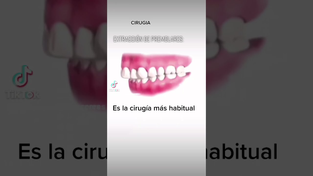 EXTRACCION DE PREMOLARES con fines ortodonticos (CIRUGÍA Y ORTODONCIA ...