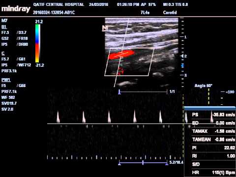 carotid doppler in brain death - YouTube