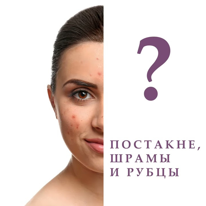 Крем от постакне Цикатрикс - YouTube