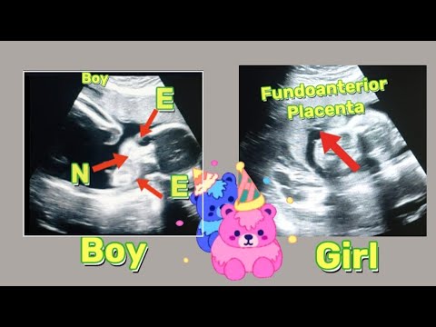 22 wk Fetal heartbeat anomaly ultrasound | Fundal Anterior placenta ...
