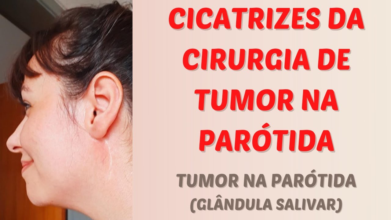 Tumor De Parotida Oral Medicine