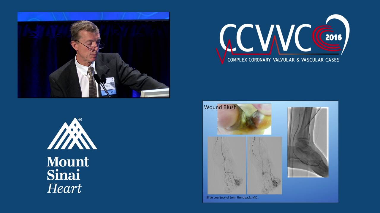 Perfusion Assessment for Critical Limb Ischemia - YouTube