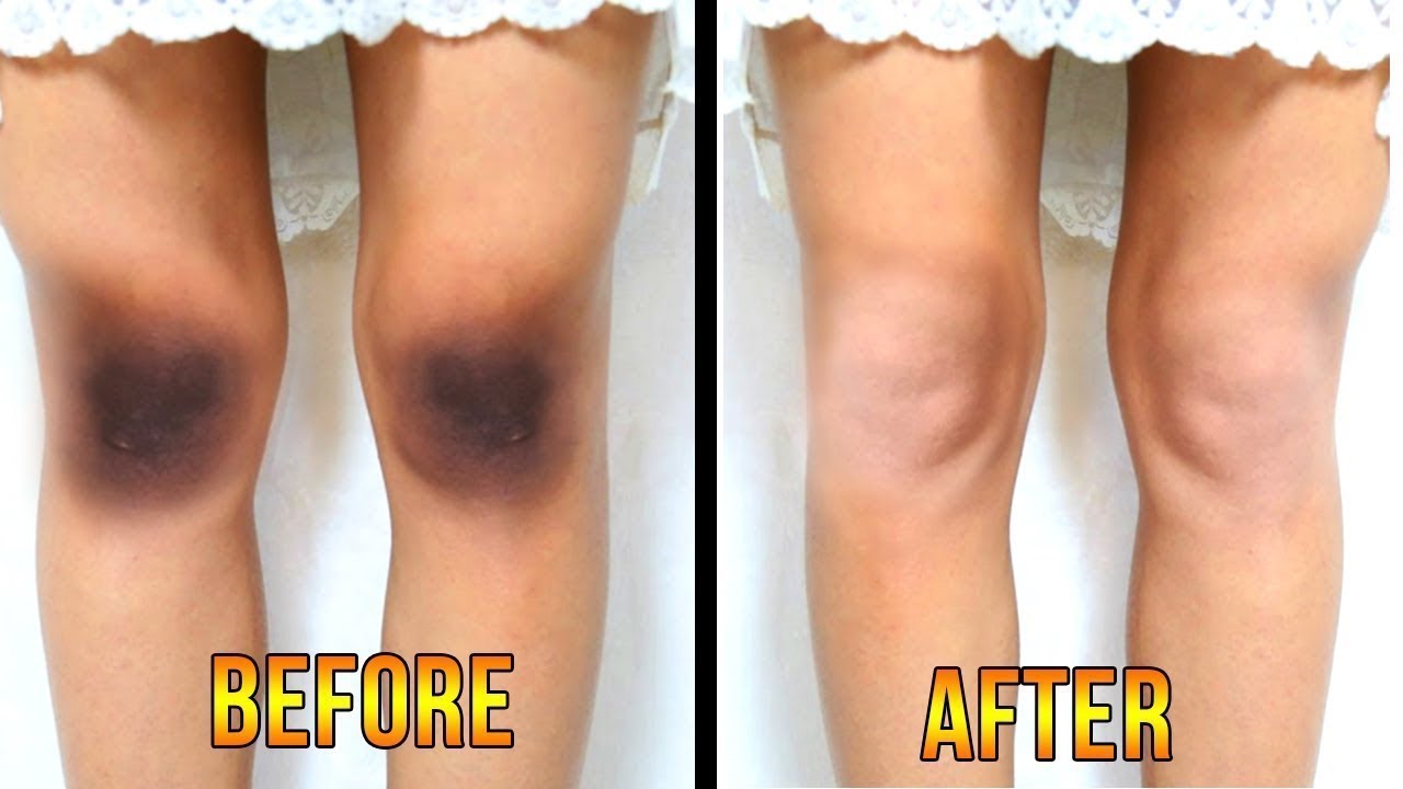 Ways To Lighten Dark Knees Elbows Beauty Tips In Tamil YouTube ways-to-lighten-dark-knees-elbows-beauty-tips-in-tamil-youtube