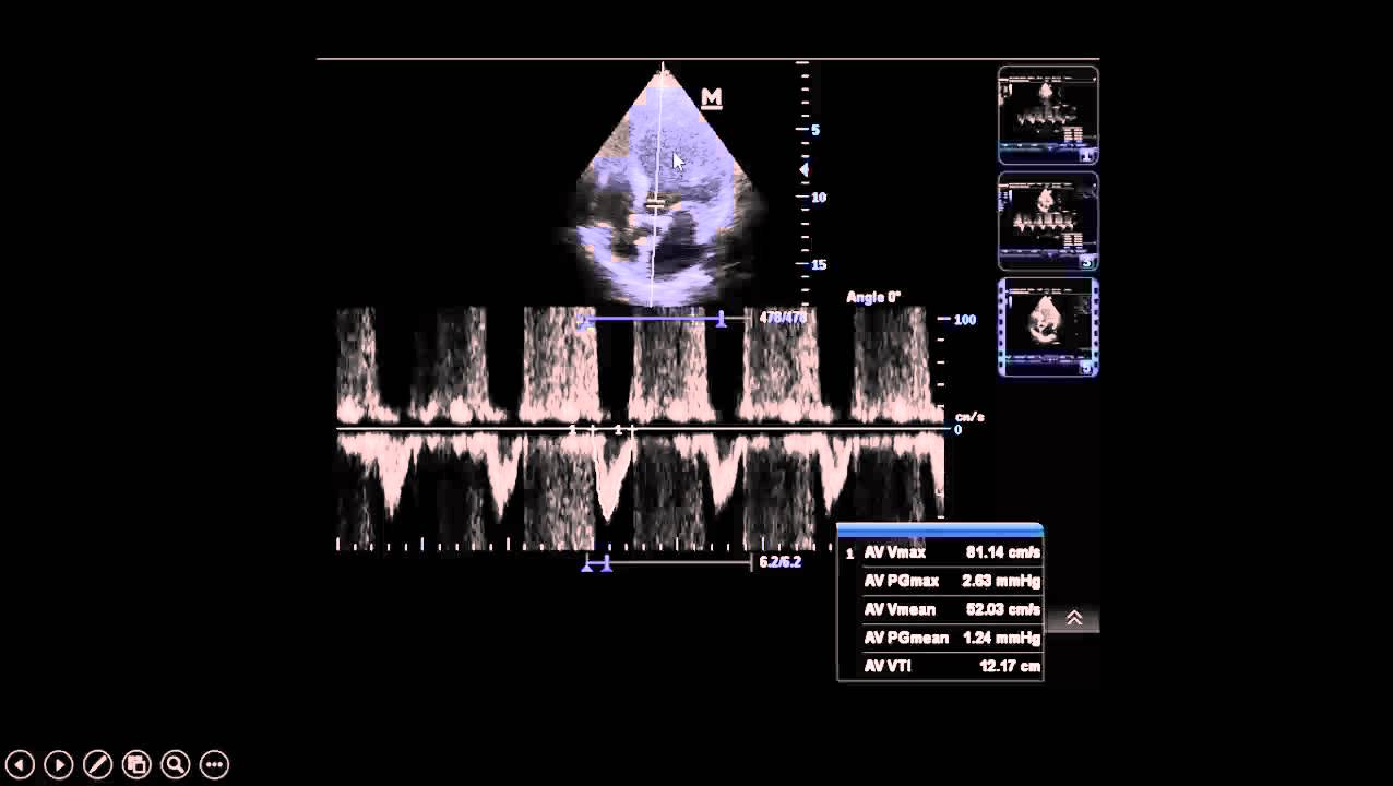 critical care U/S protocol 2, treating shock, step by step approach ...