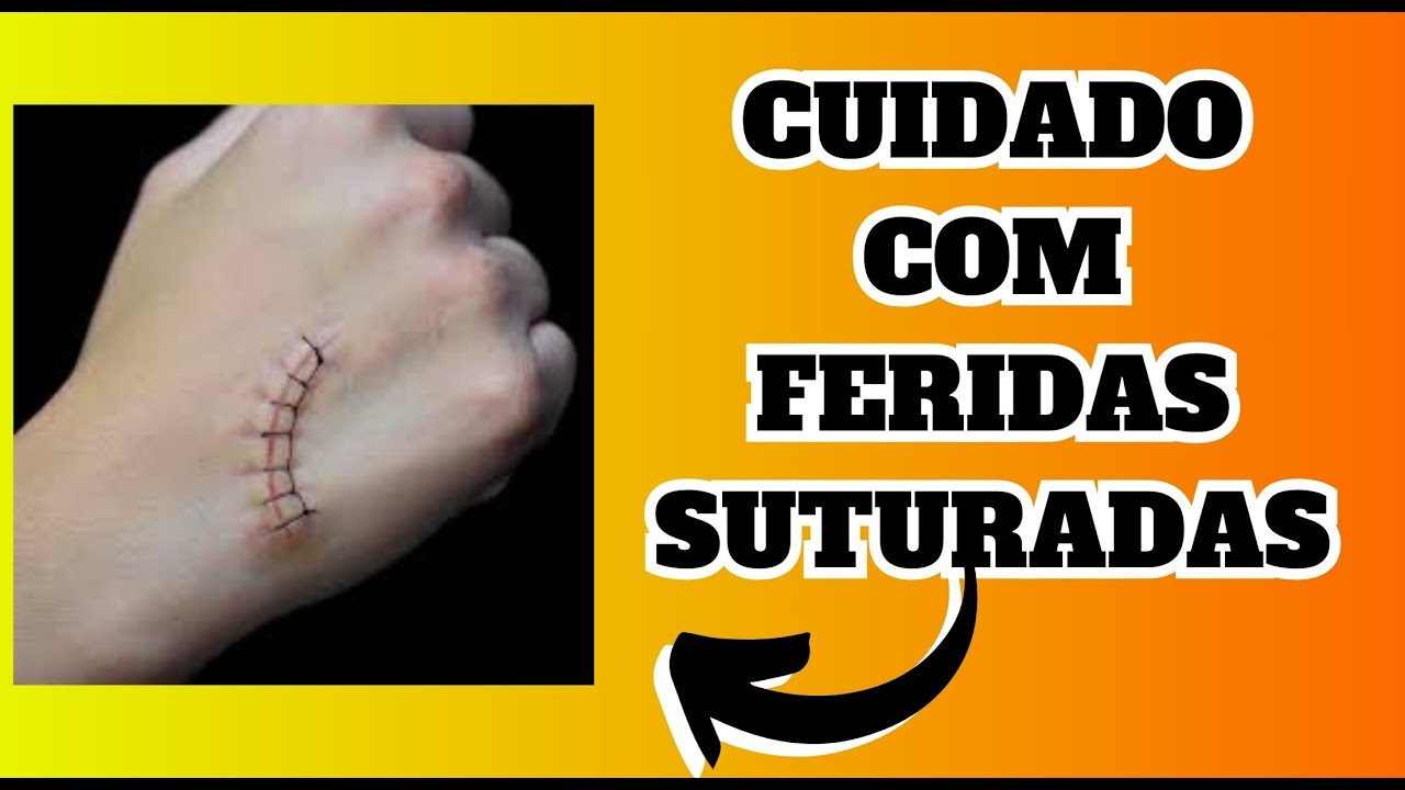 COMO CUIDAR ADEQUADAMENTE DE FERIDAS QUE FORAM SUTURADAS - YouTube