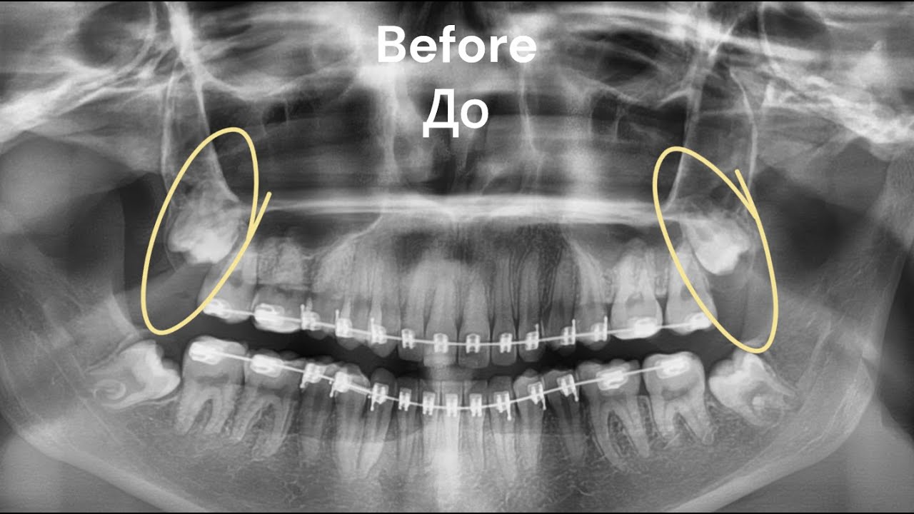 Extraction of impacted upper wisdom teeth - YouTube