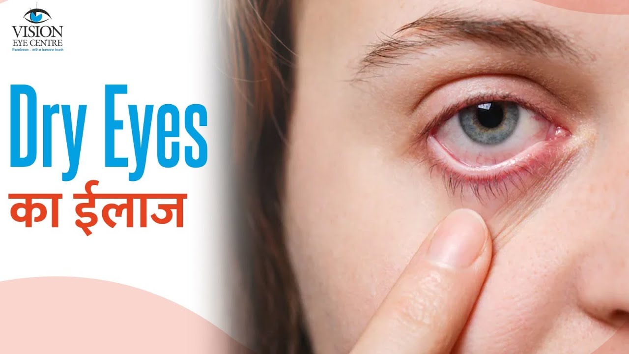 Dry Eyes : Causes, Syndrome & Treatment ( आंखों में सूखापन ) | Dry Eyes ...