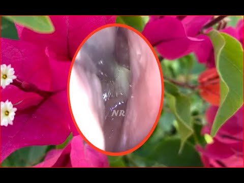 ear wax removal satisfying || ear wax blockage removal - YouTube