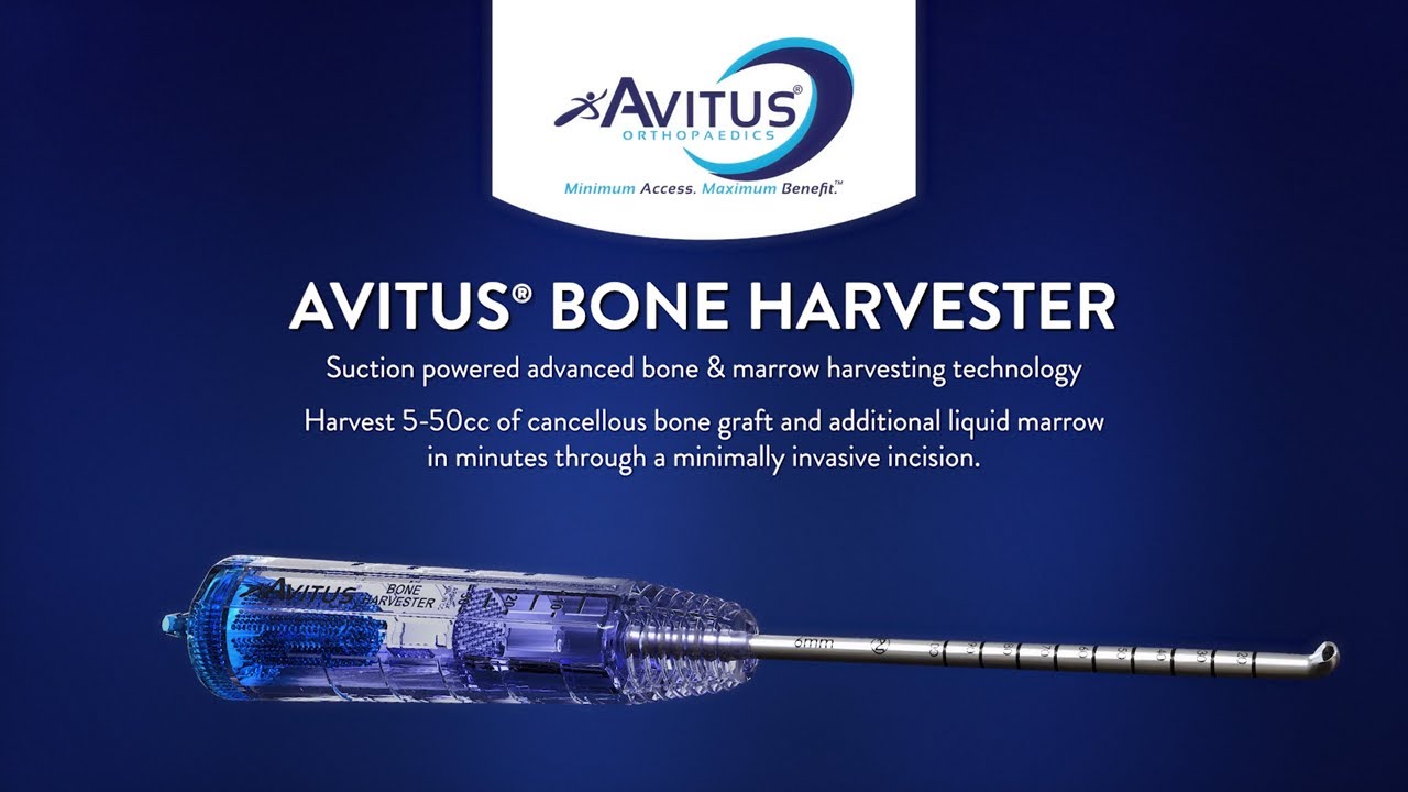 Avitus® Bone Harvester – 6mm Edition Product Launch - Calcaneus Demo ...