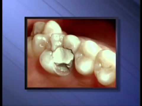EXTRACTION DECAYED TOOTH - YouTube