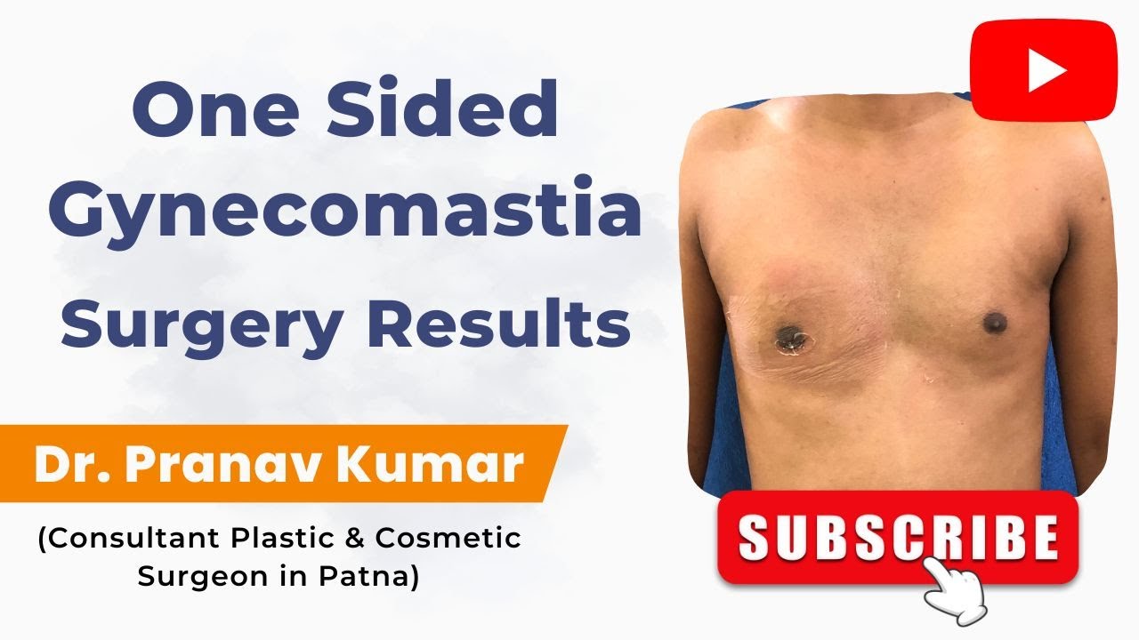 One Sided Gynecomastia Surgery Results | Grade 2 Gynecomastia | Dr ...