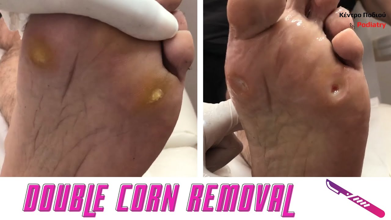 Τwin corns removal|Αφαίρεση κάλων| Αφαίρεση τύλων| Κέντρο Ποδιού ...