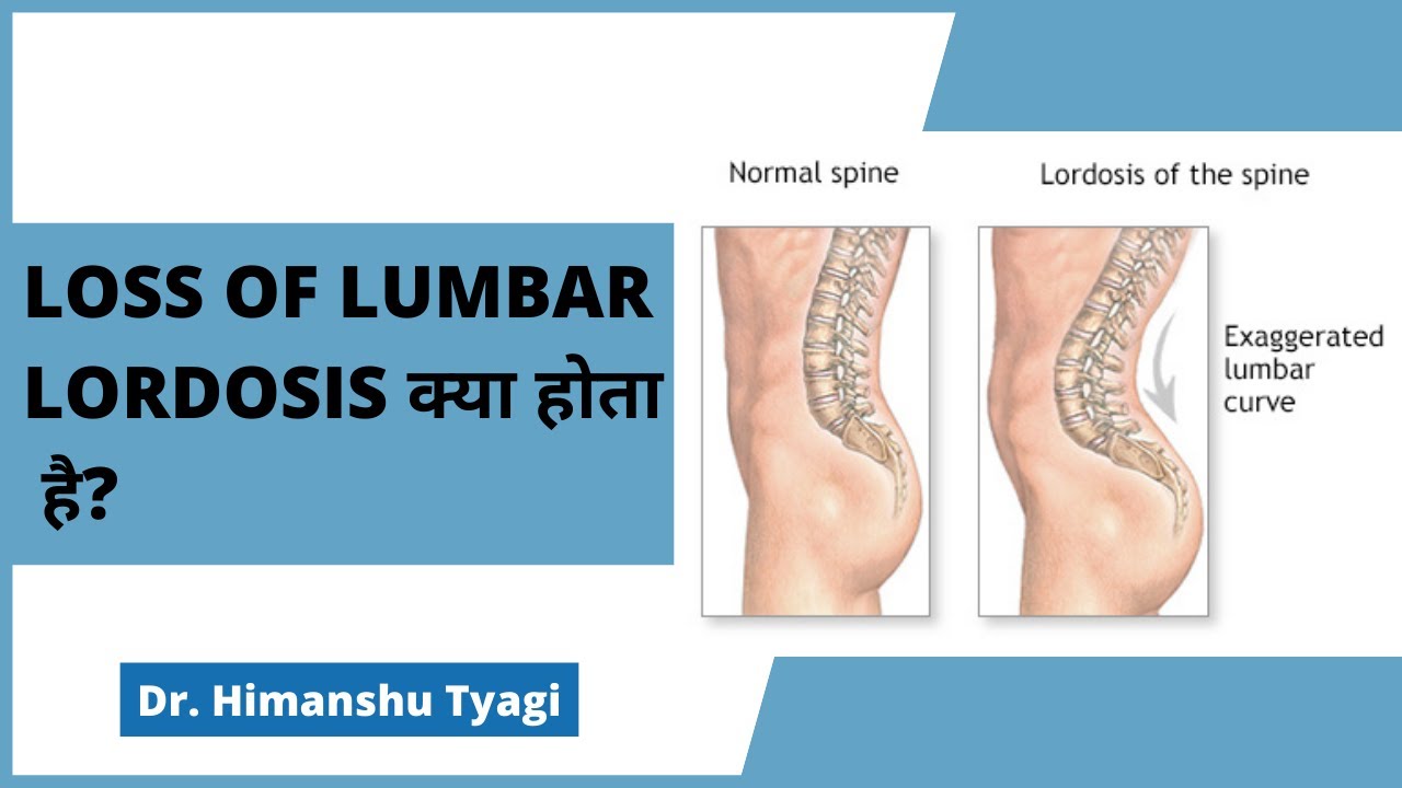 Loss of Lumbar lordosis क्या होता है? - YouTube