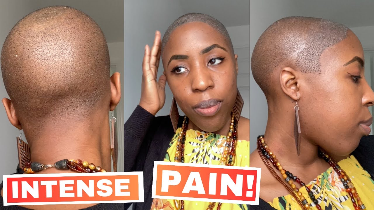 Hair Transplant Aftercare- Day 7 - Intense Pain, Itching, Aloe Vera Gel ...