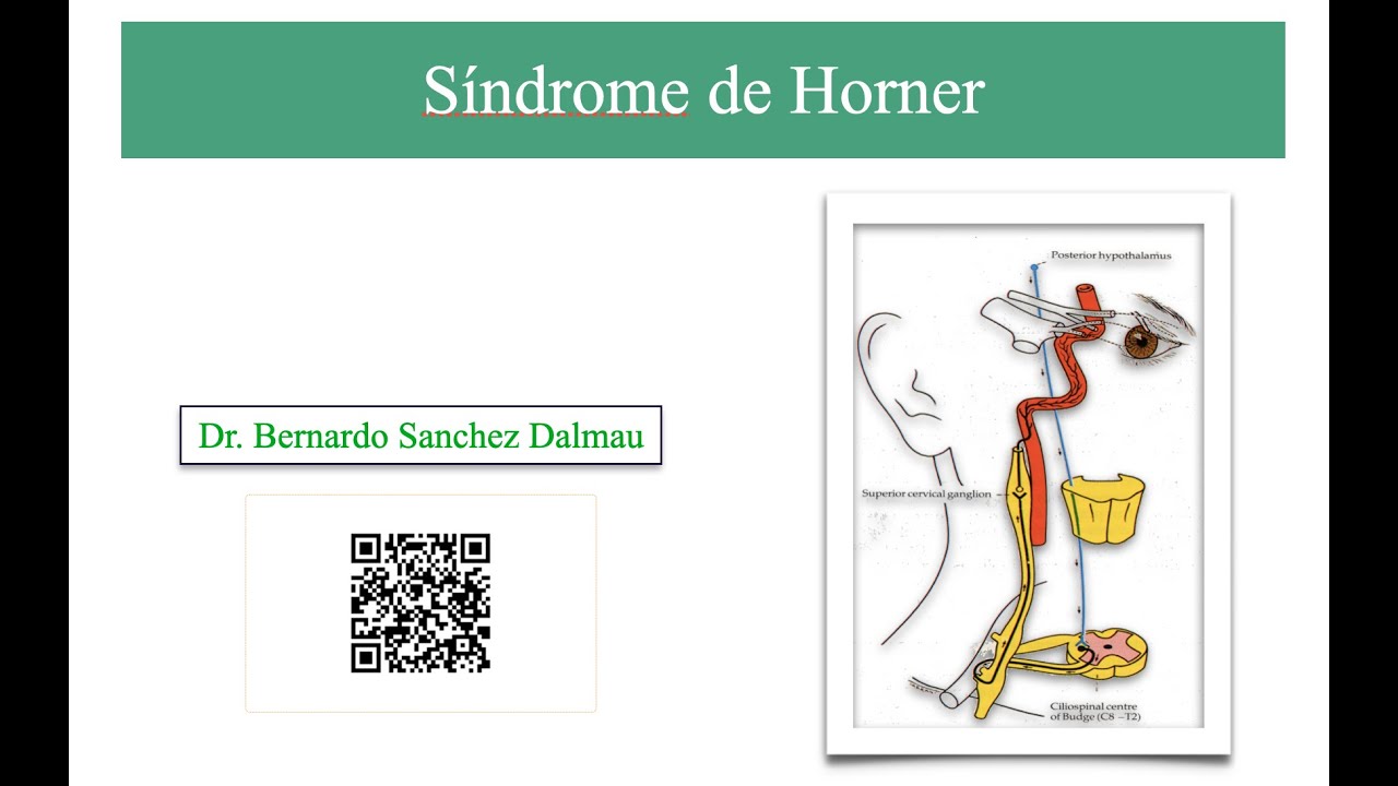 Síndrome de Horner. - YouTube