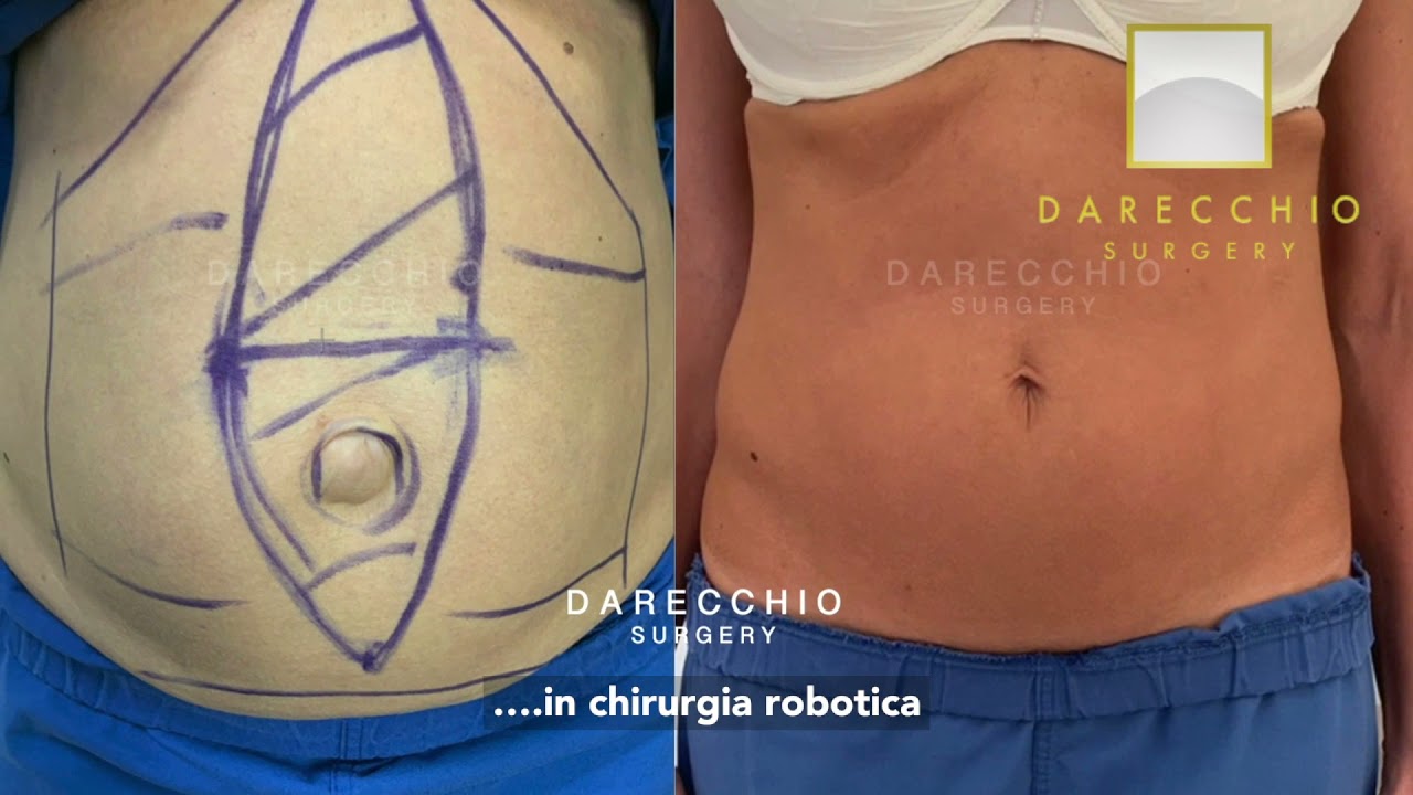 Diastasis Recti - Umblilical hernia | Scarless Robotic Reconstruction ...