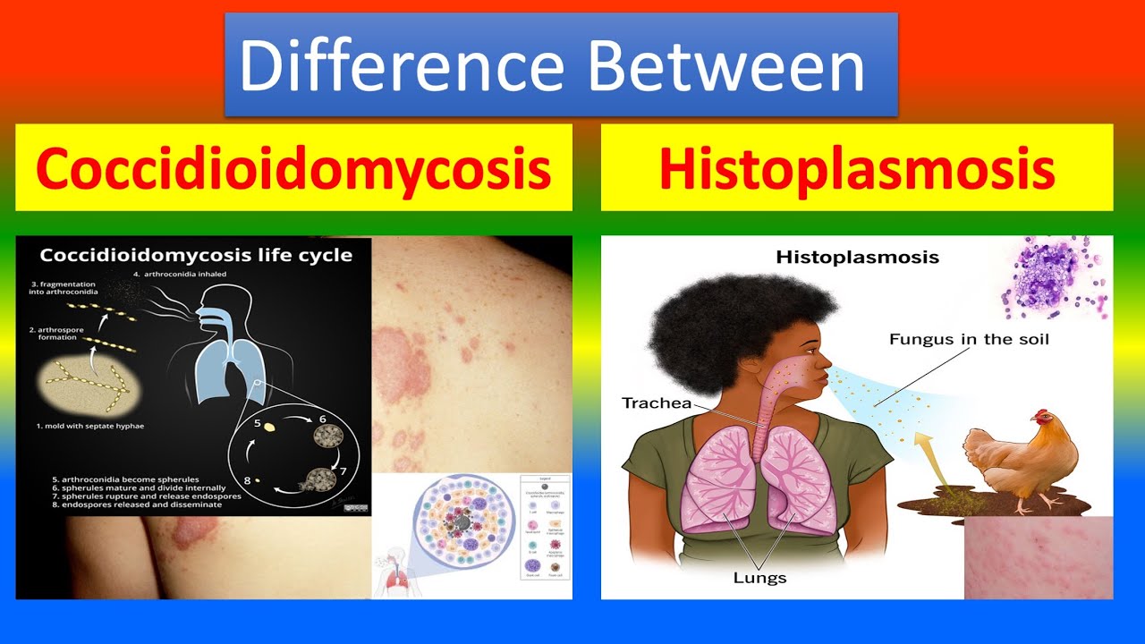 Difference between Coccidioidomycosis and Histoplasmosis - YouTube