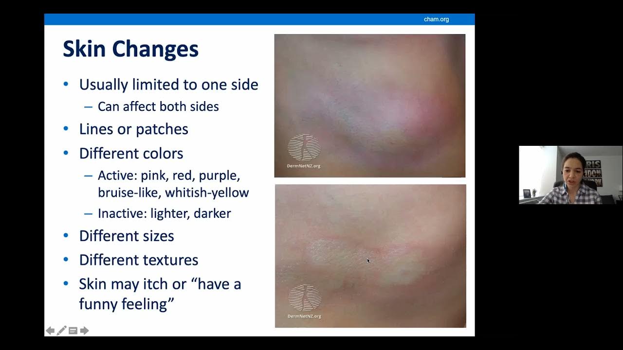 Localized Scleroderma Overview - YouTube
