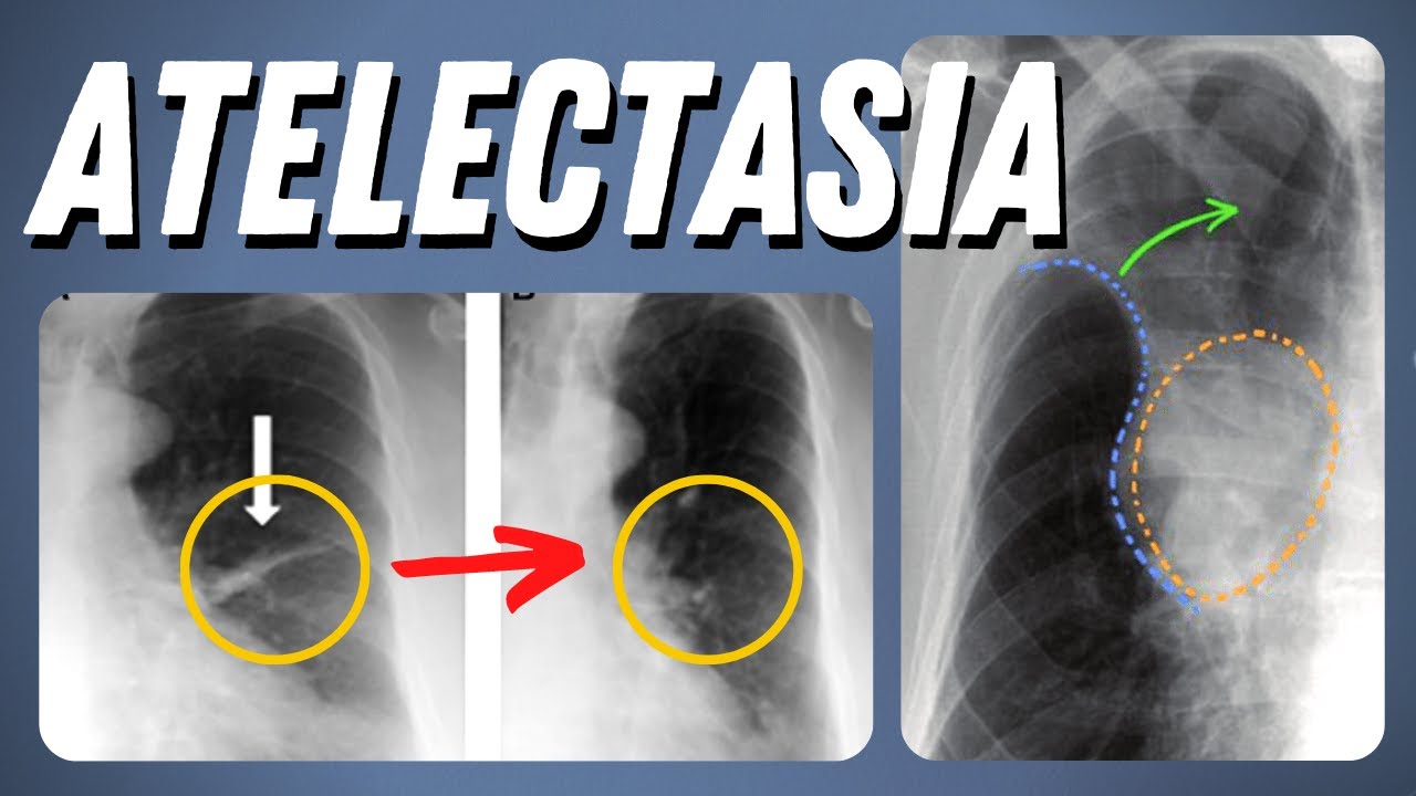 Diagnóstico de Atelectasias Explicado Claramente - YouTube