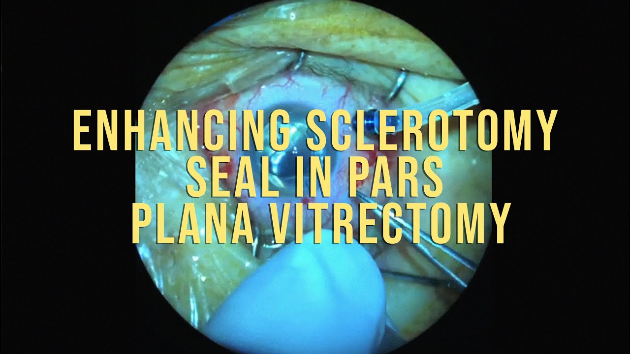 Enhancing Sclerotomy Seal in Pars Plana Vitrectomy - YouTube