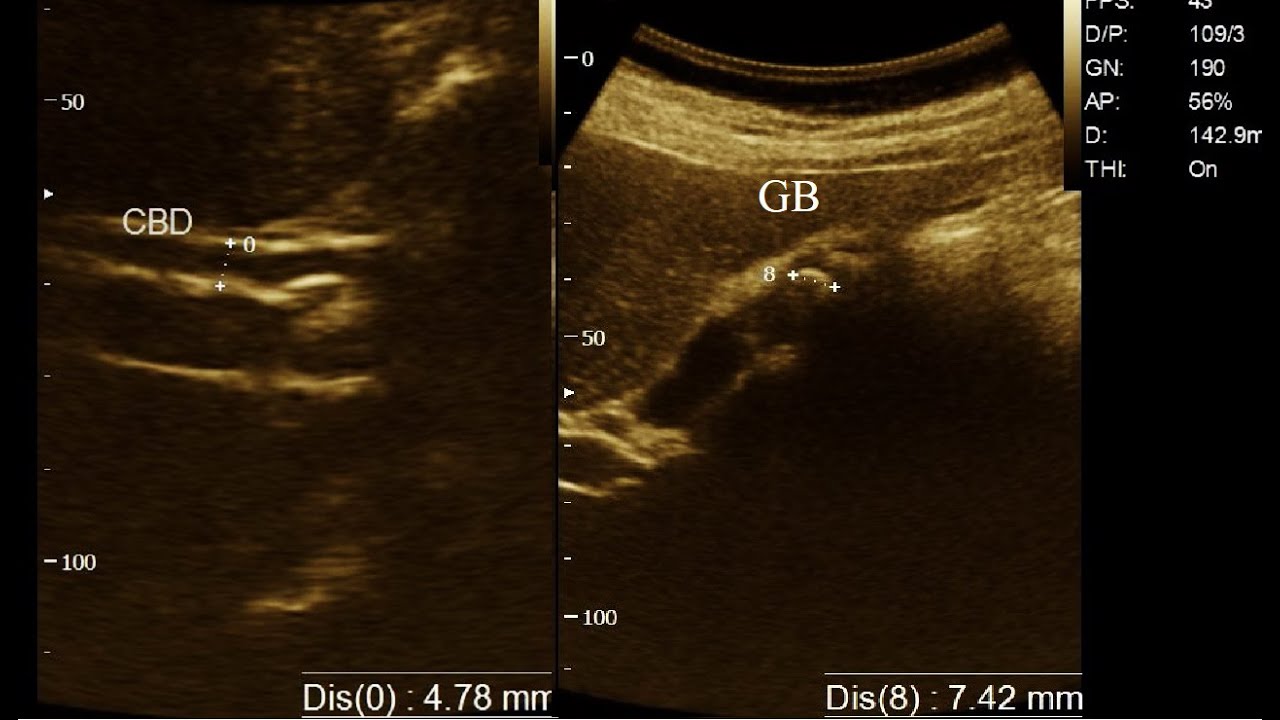 Calculus Cholecystitis | Biliary tree is mild dilated | Amader hospital ...