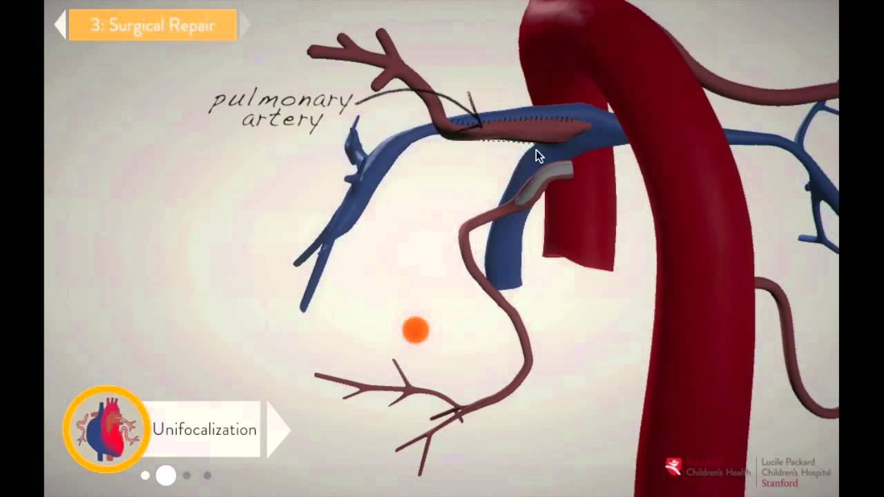Chapter 3: Unifocalization & Repair - Stanford Children's Health - YouTube