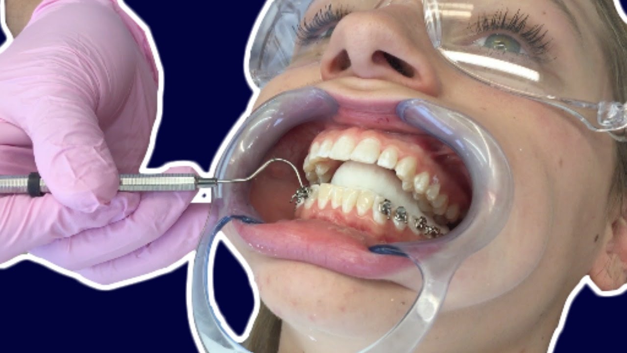 Mijn slotjes beugel wordt geplaatst?!! - YouTube