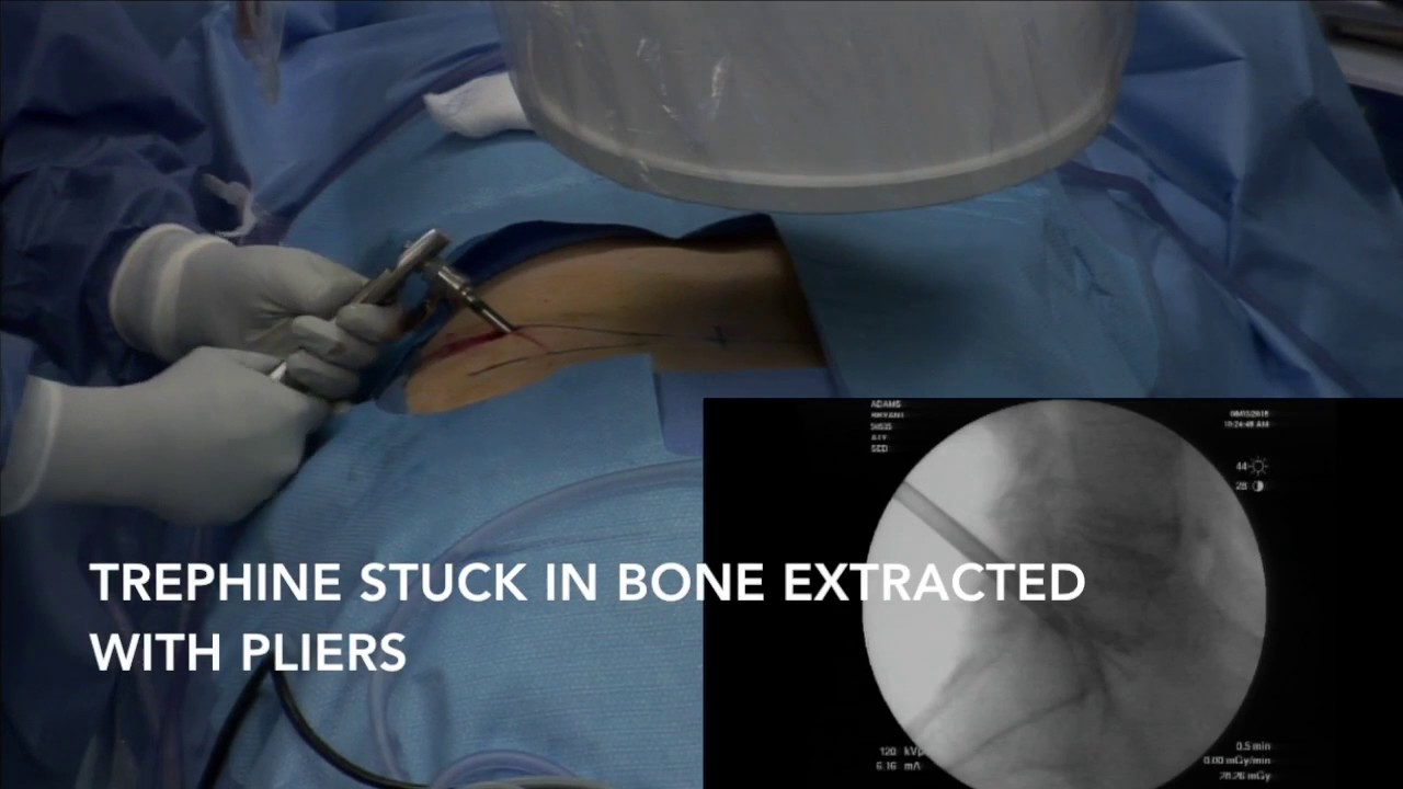 Endoscopic Spine Surgery | End Plate Abnormalities Are A Pain Generator ...