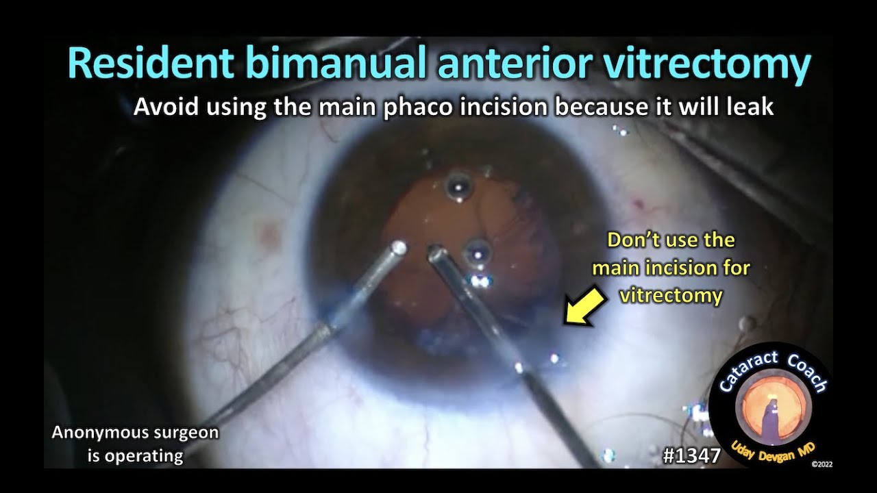 Vitrectomy