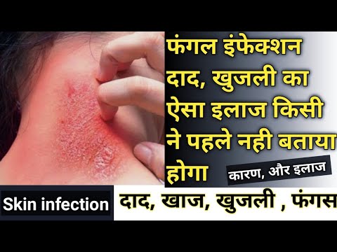 daad khaj khujli ki dawai | fungal infection | kharish ka ilaj | दाद ...