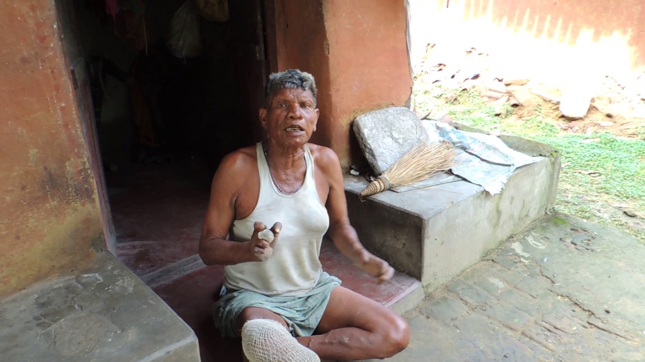Leprosy Victim in Leper Colony, West Bengal - YouTube