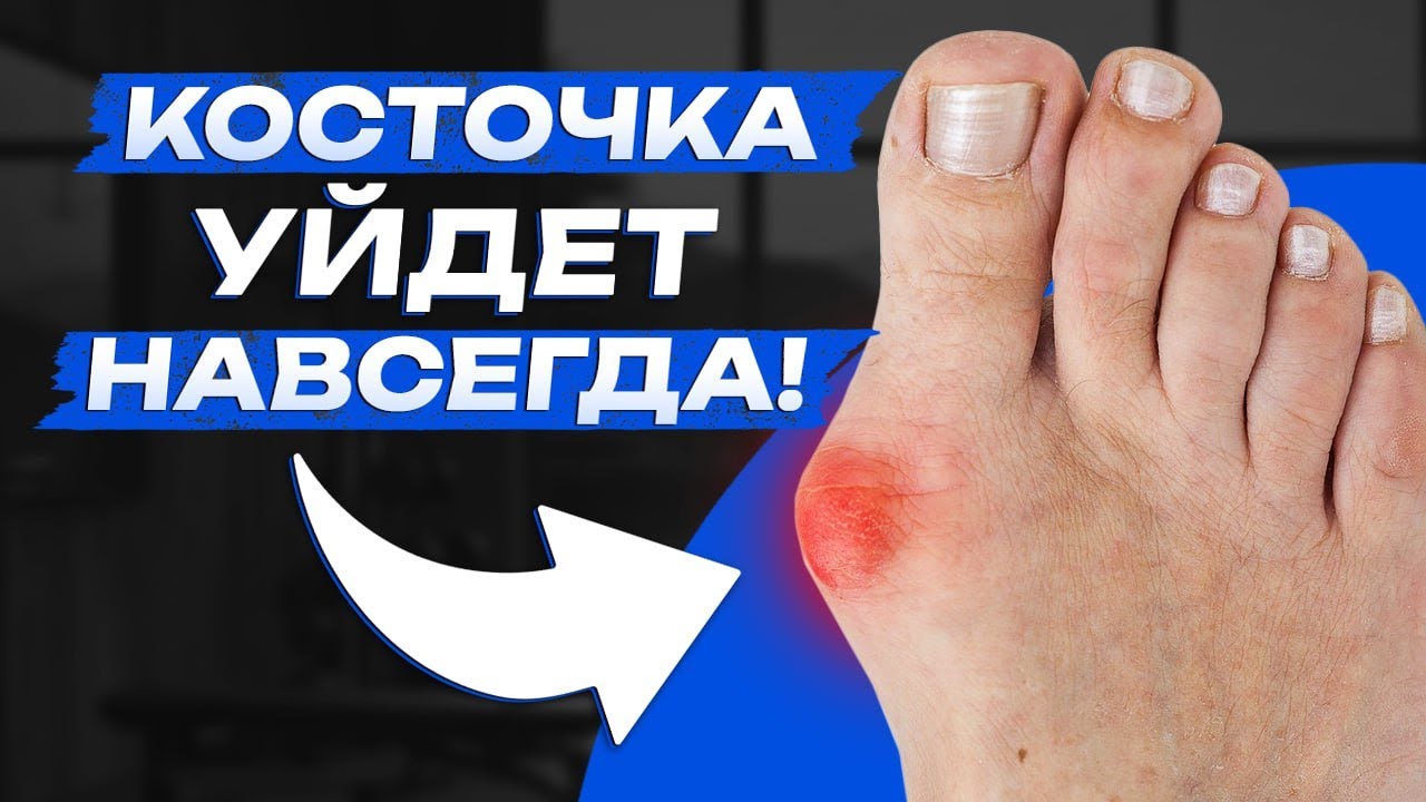 Ваши ноги скажут вам СПАСИБО 5 эффективных упражнений от халюс