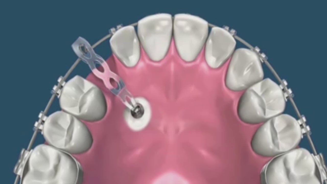 Dentes Inclusos: Como tratar? - YouTube