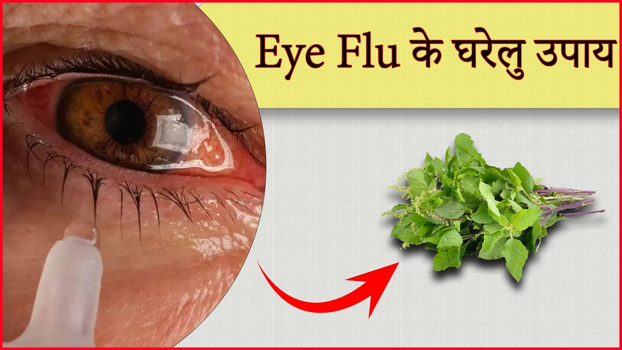 Eye Flu के घरेलु उपाय !! eye flu hone par kya karen !! eye flue home ...
