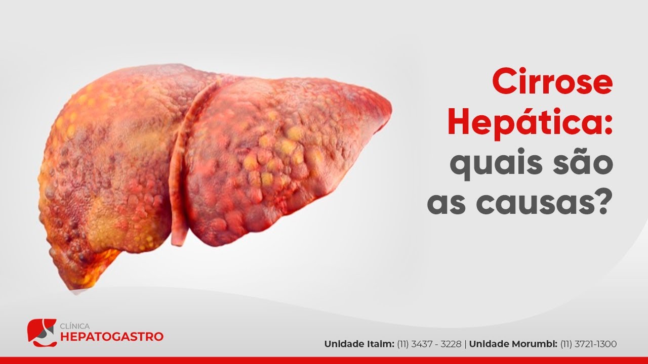 Cirrose Hepática: quais são as causas? | Dr. Paolo Salvalaggio CRM ...