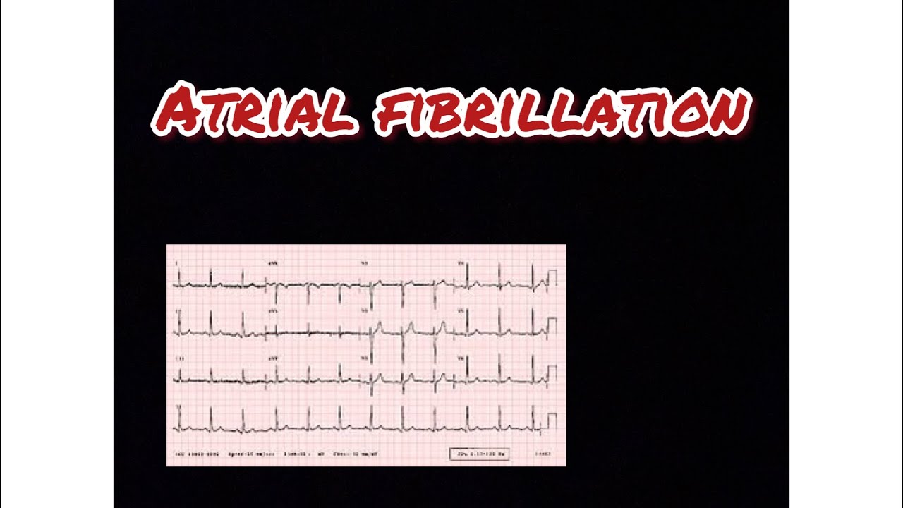 Atrial fibrillation - YouTube