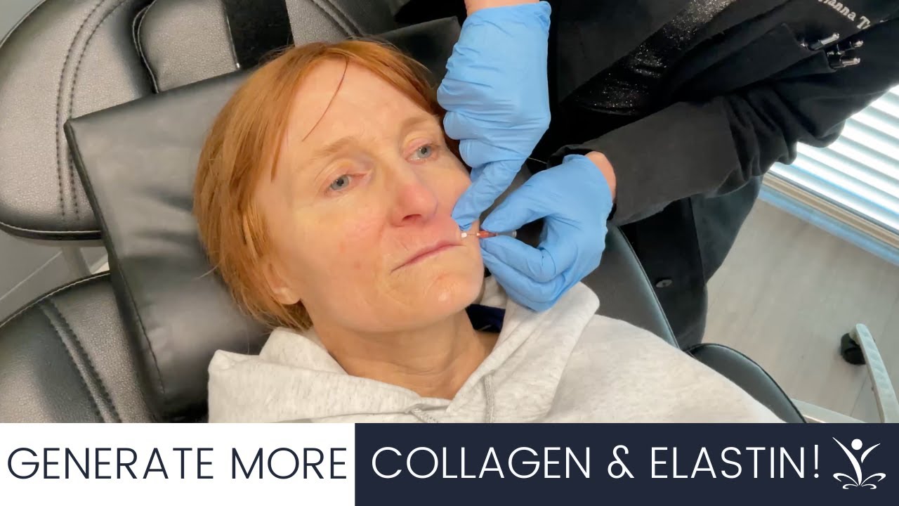 PDO Threads for Lip Lines - YouTube