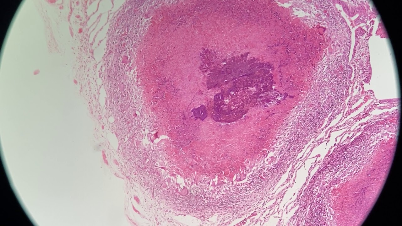 Granuloma pulmonar (Tuberculose) - YouTube