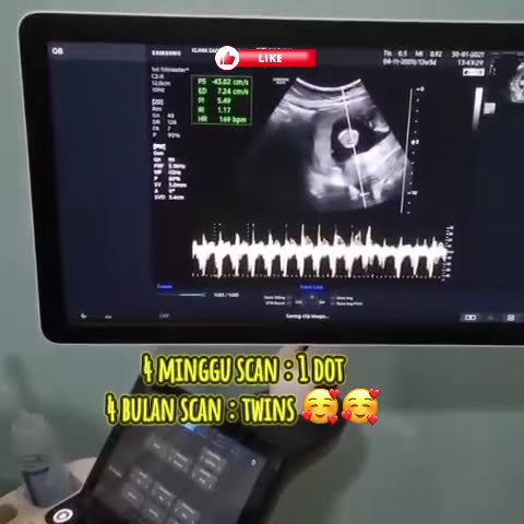 4 Bulan Scan Rupanya Twin/Kembar 🫶🏻 ️#twinspregnancy #kandungankembar # ...