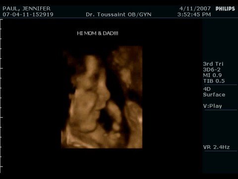 Sullivan vomiting in the womb