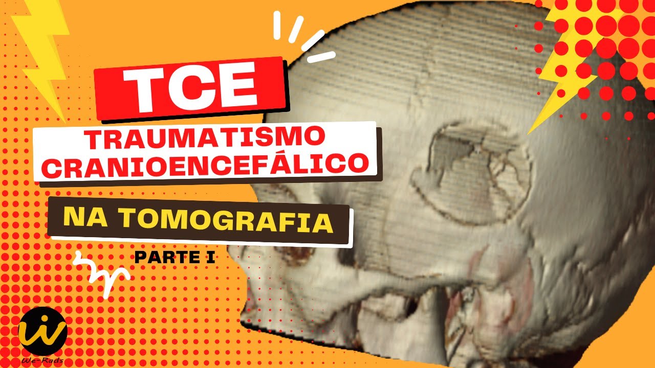 TRAUMATISMO CRANIOENCEFÁLICO / TCE - Tomografia de Crânio no Trauma ...