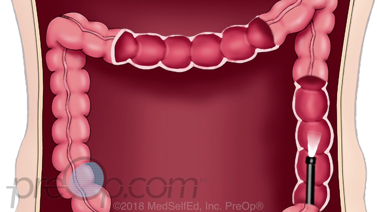 Colonoscopy Lower Endoscopy PreOp® Patient Education and Engagement ...