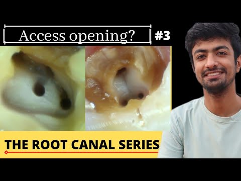 Access opening| Pre-Endo build-up| How Many canals? | Dental ji |Basic ...