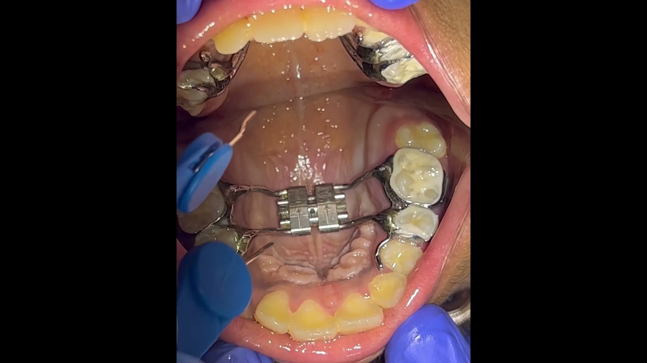 #Rapid maxillary #Expansion for skeletal jaw expansion in patients with ...