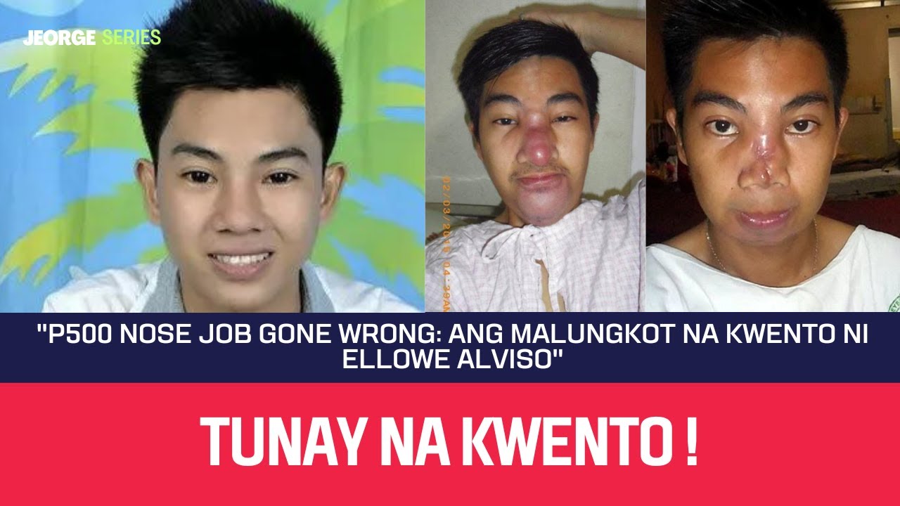 "P500 Nose Job Gone Wrong: Ang Malungkot na Kwento ni Ellowe Alviso ...