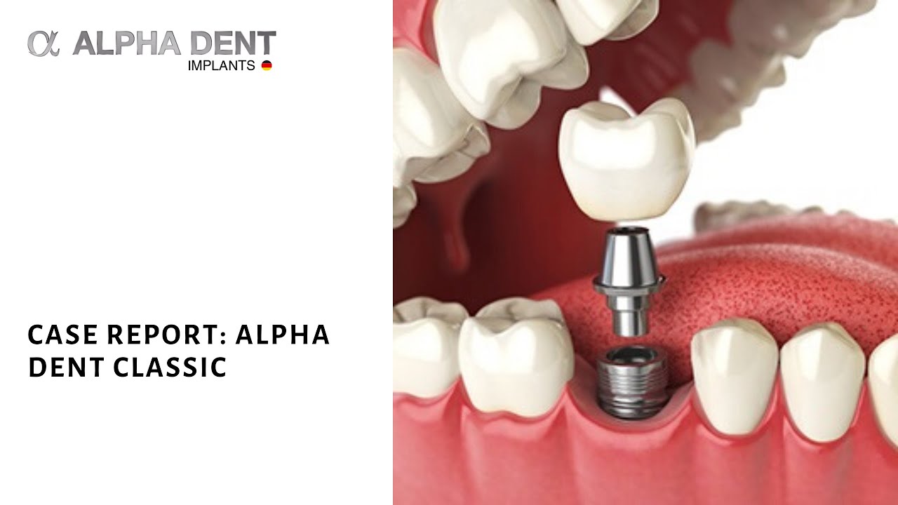 Case report: Alpha Dent Classic - YouTube