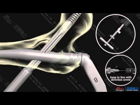 PF Gamma intramedullary nails system__Leon - YouTube