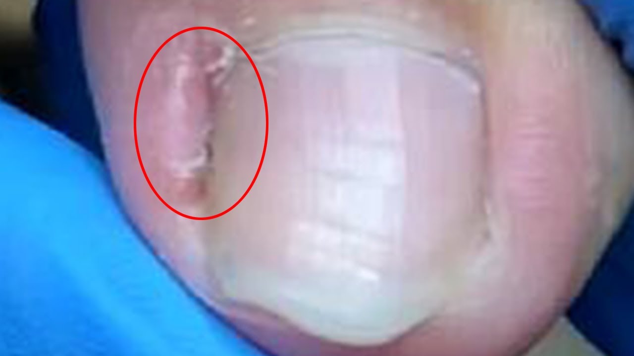 Tutorial de pedicura: tratamiento cuidadoso de las uñas encarnadas ...