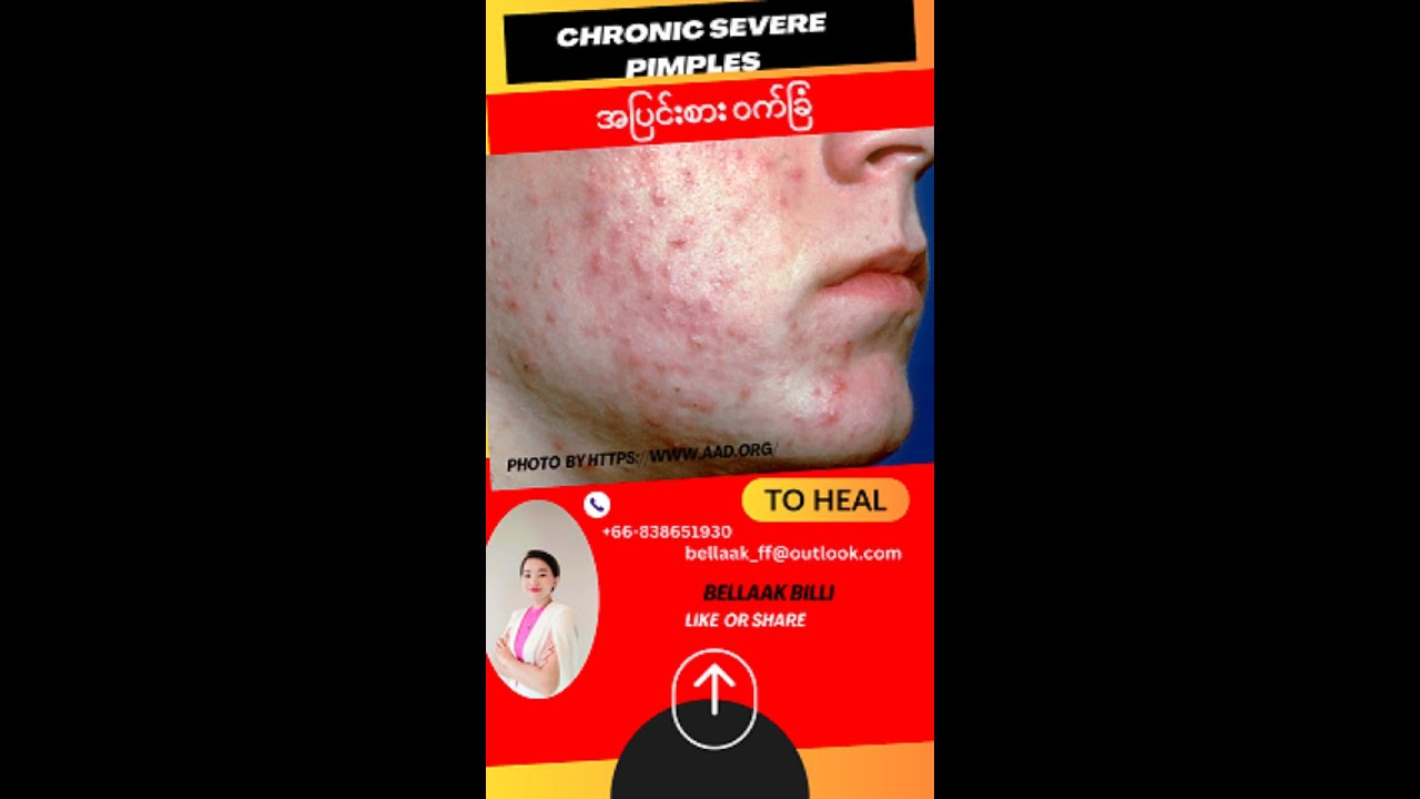 CHRONIC SEVERE PIMPLES #chronicrc #pimplepopping #face #beautiful # ...